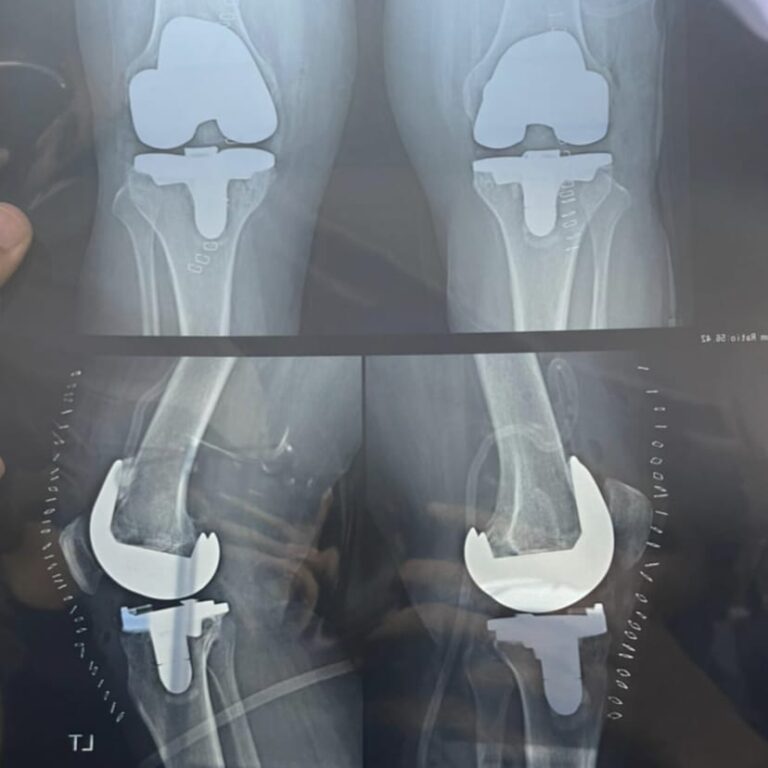 Physiotherapy after Total knee replacement (TKR) in Lahore, Pakistan - The Meer's Physiotherapy ...